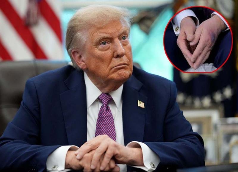 Blue mark on Trump's hand…..due to taking excessive dose of this ...
